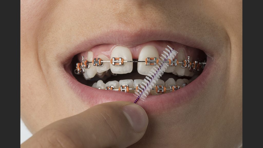 Don't be deceived by fake dental braces by uncertified dentists