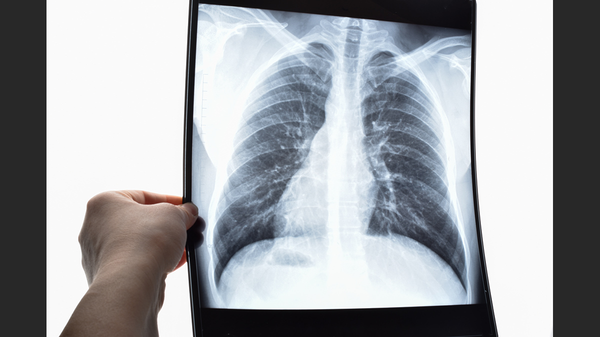 Chest X Ray Smoker Vs Nonsmoker